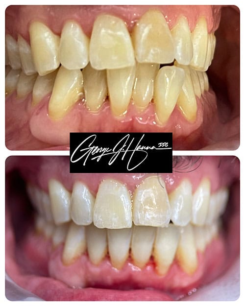 Invisalign in Los Feliz, CA | Inspired Smiles